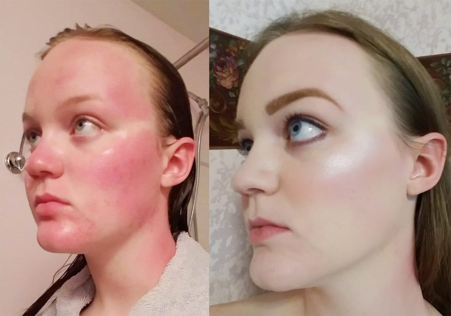 How To Cover A Burn Blister With Makeup Mugeek Vidalondon