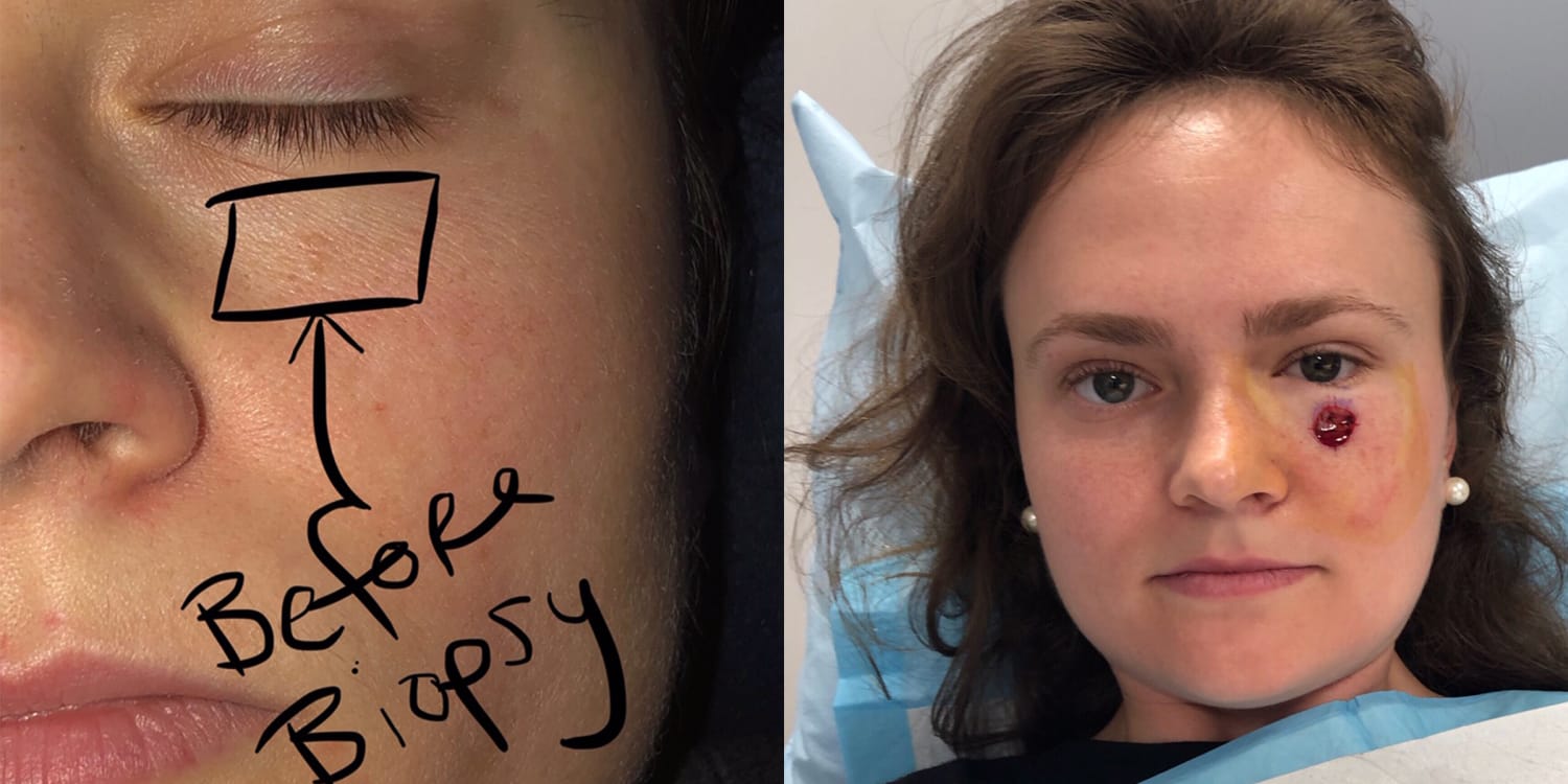 Sublinhado Surpreendase Conselho Symptoms Of Skin Cancer On Face