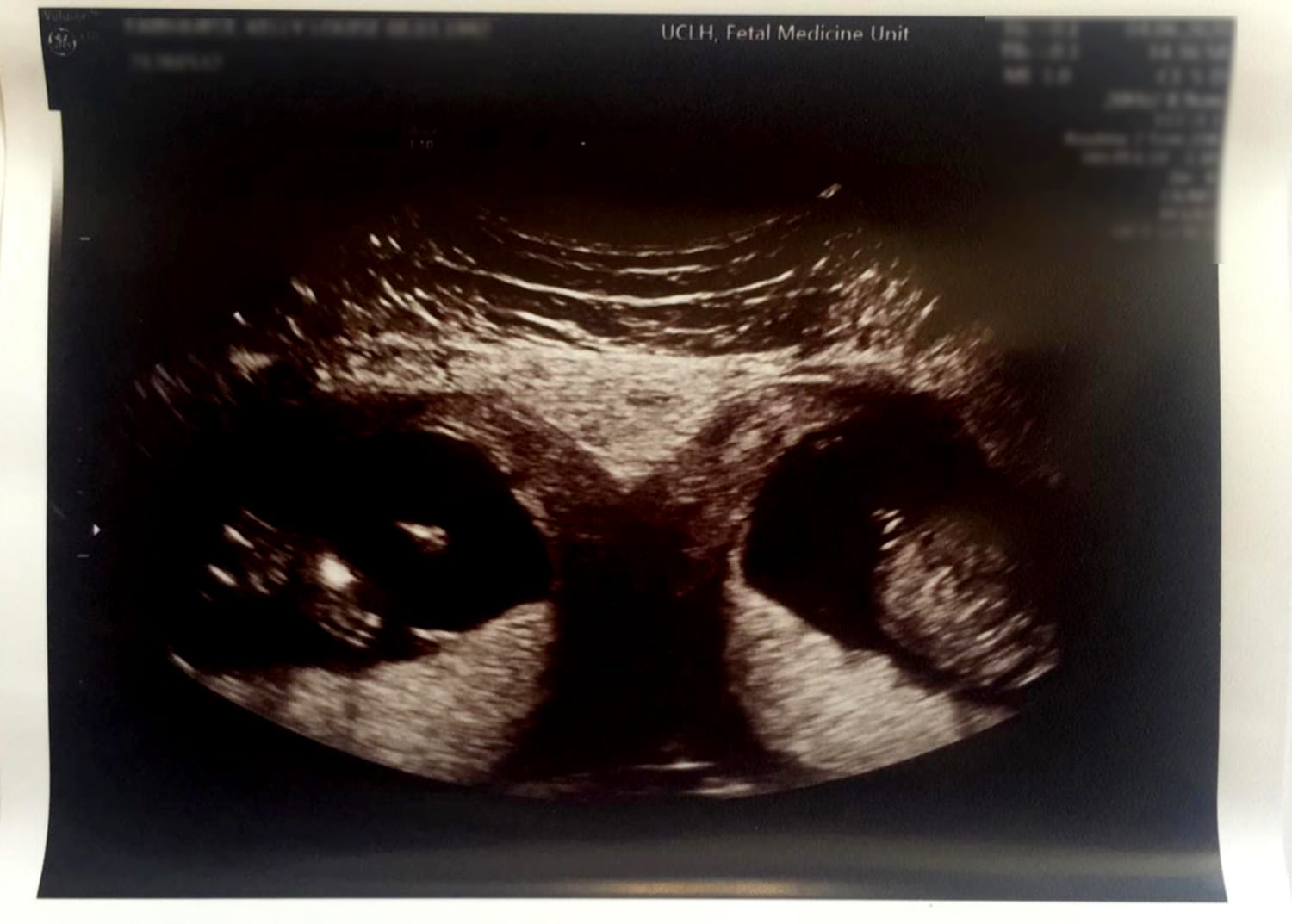 Pregnant Uterus Twins