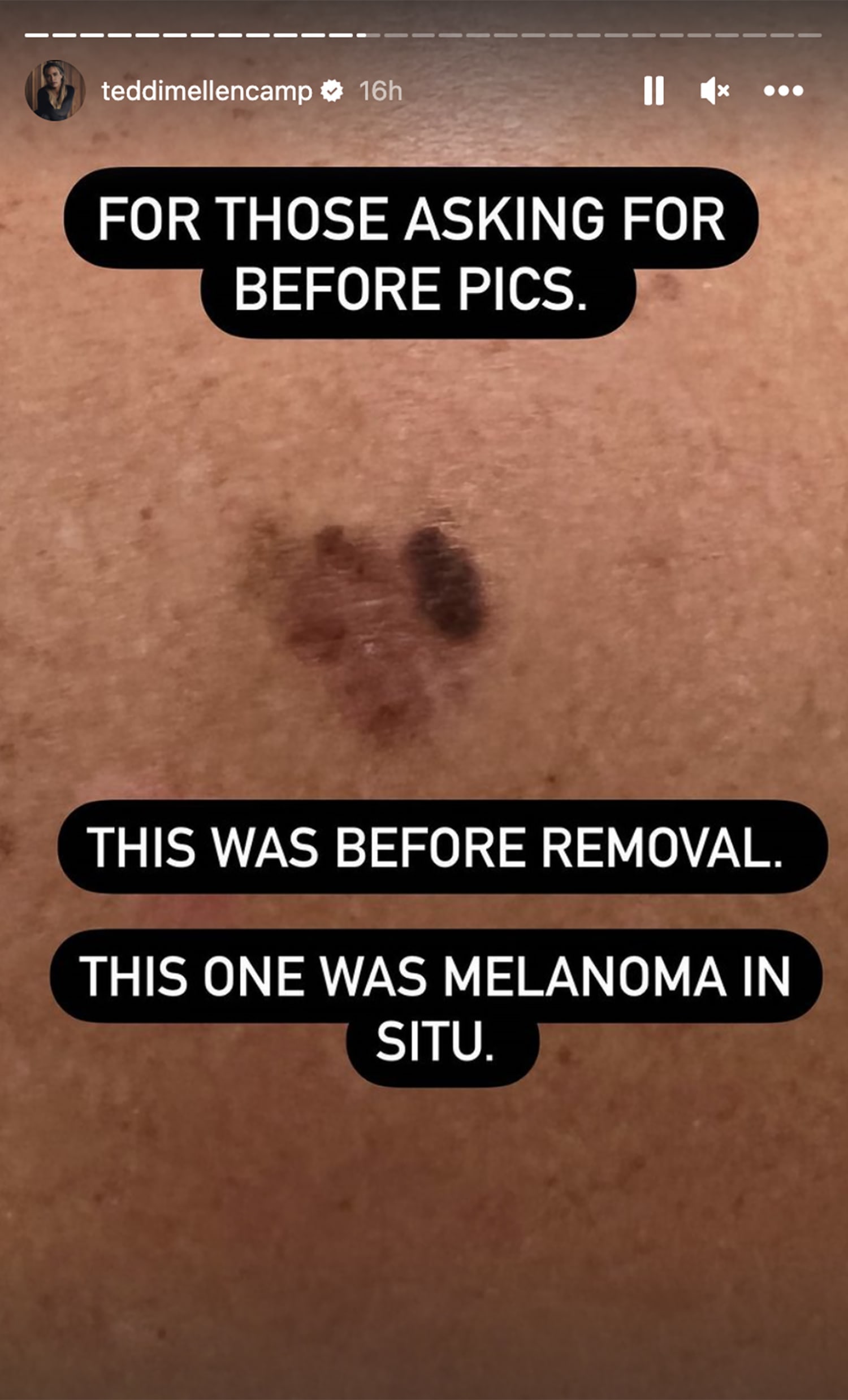 Stage 2 Melanoma What Is Stage II Melanoma?