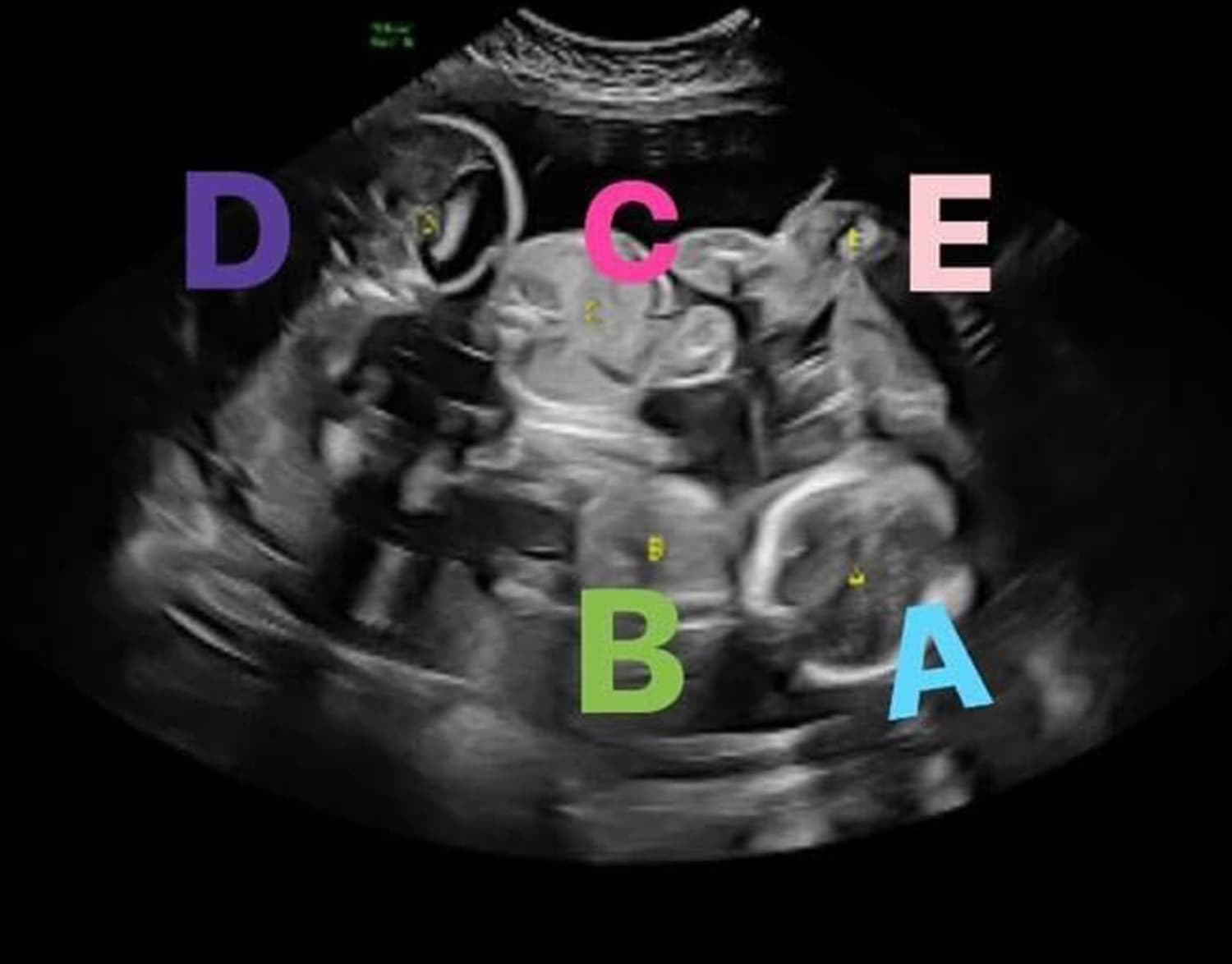 Quintuplets In The Womb Healthy Quintuplets Waiting To Go Home After