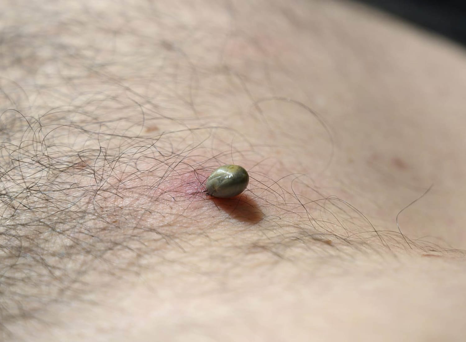 What Does A Tick Bite Look Like Before The Bullseye - Infoupdate.org