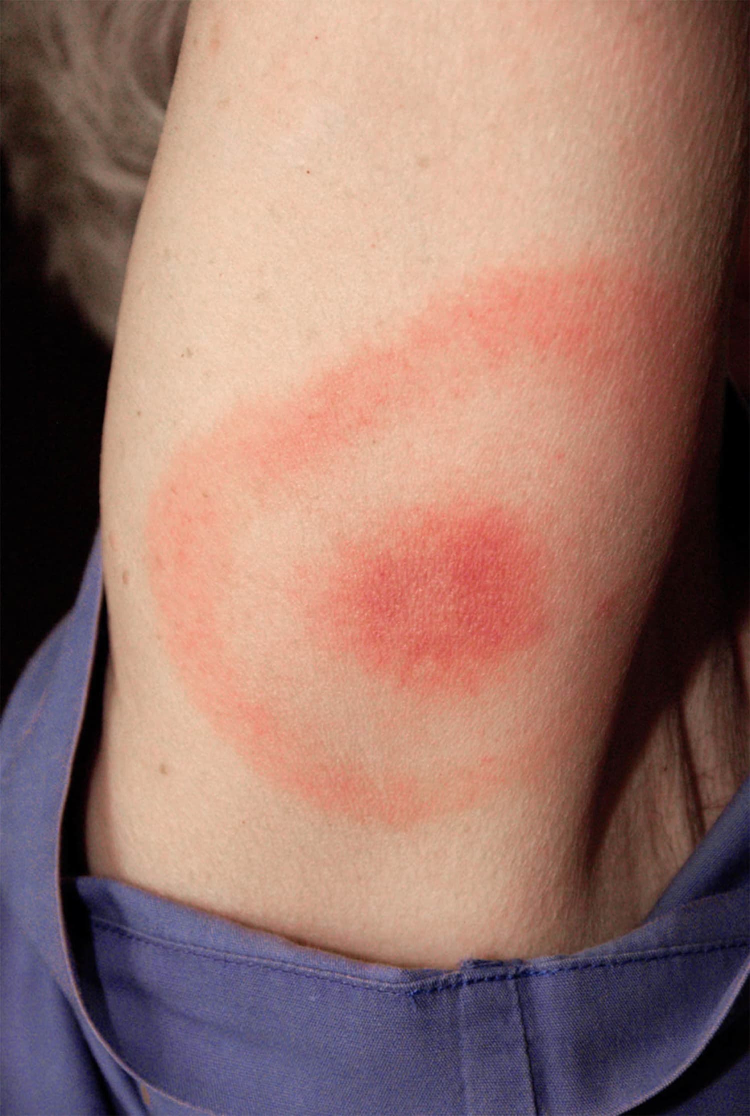 What Do Tick Bite Marks Look Like - Infoupdate.org