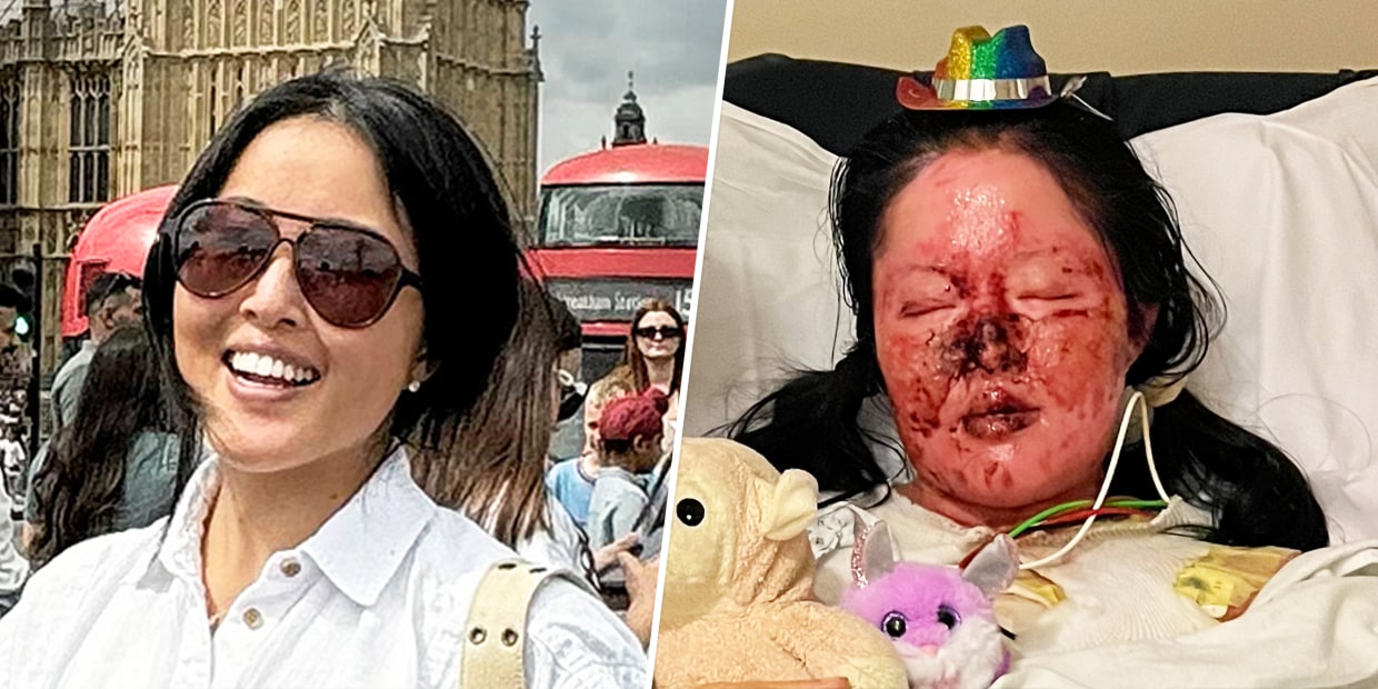 Stevens Johnson Syndrome After