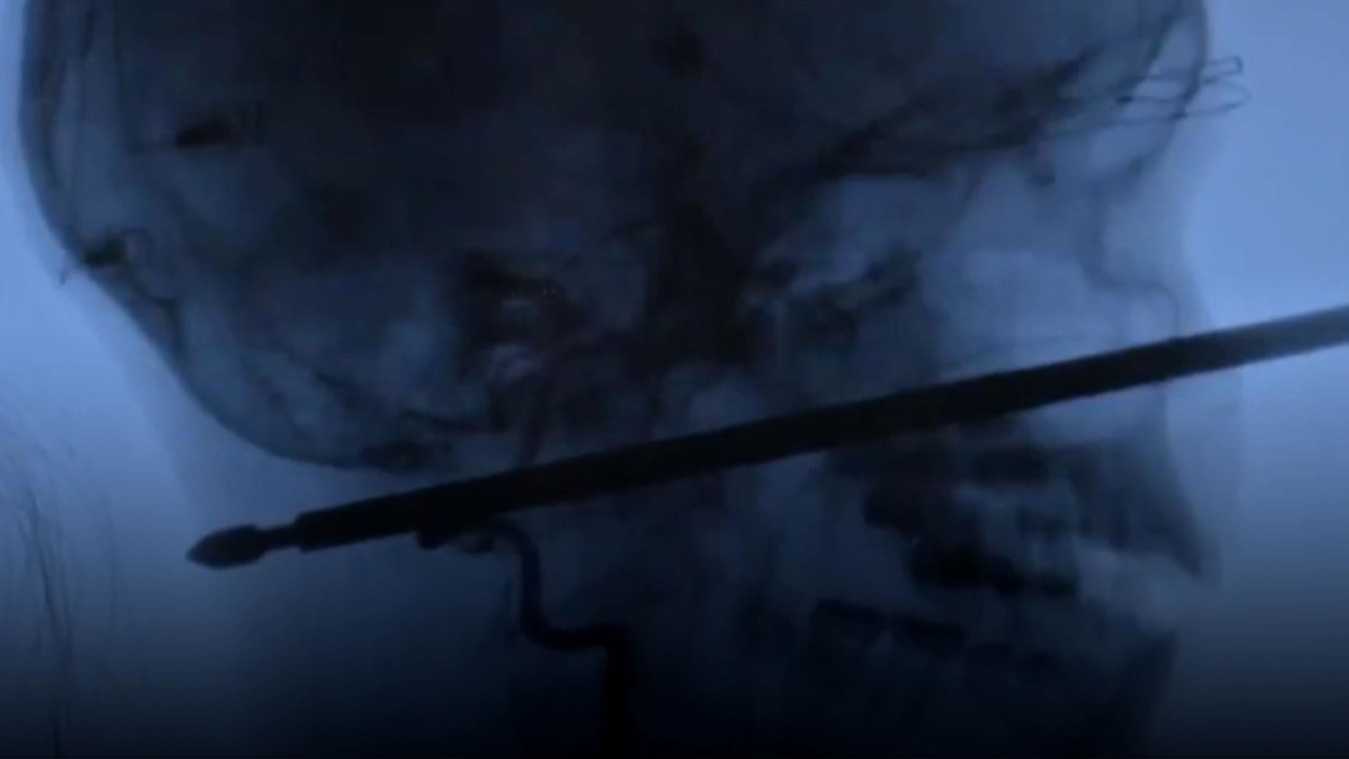 impaled through the head