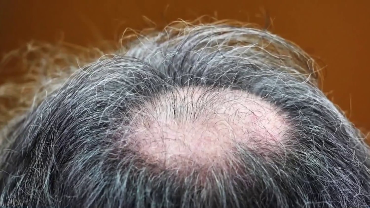 finasteride side effects men