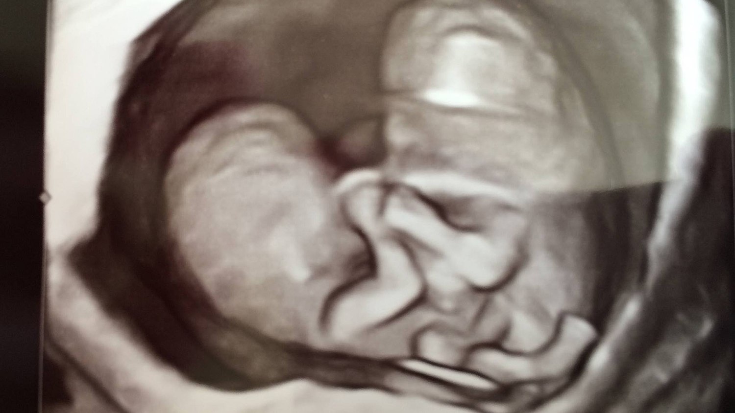 Twin Babies 3d Ultrasound 3D US Of A Twin Pregnancy Clearly Showing A