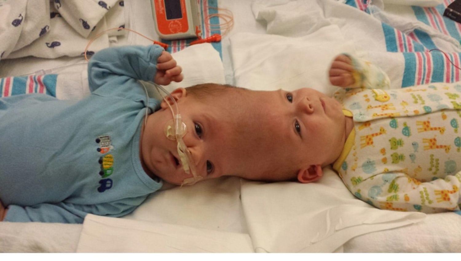 Conjoined Twins At The Head Separated