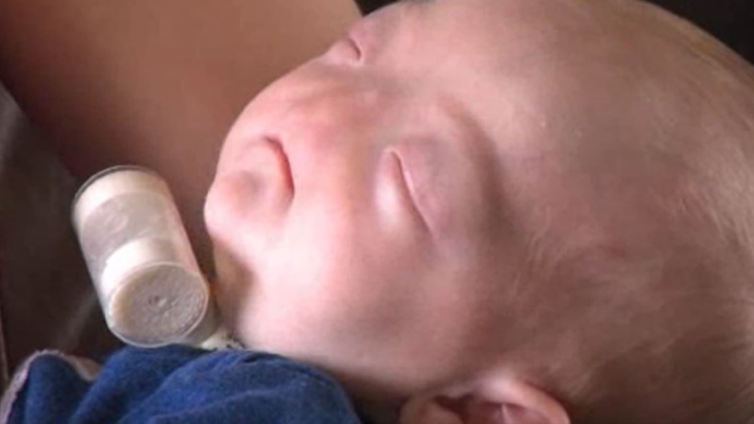 born without a nose condition