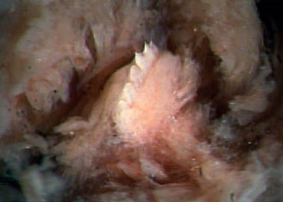 Fanged leech pulled from girl's nose