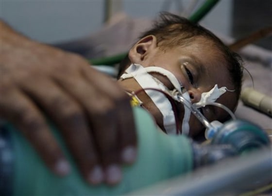 Surgeons remove two fetuses from infant