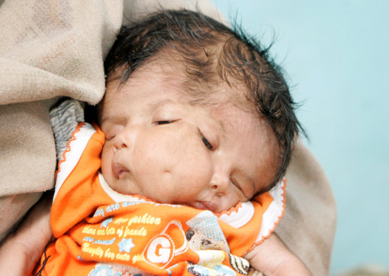 Two-faced baby's family refuses special care