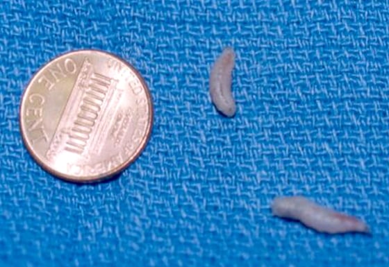 Maggots ... coming to a hospital near you