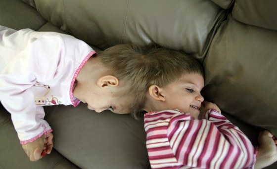 two headed human real