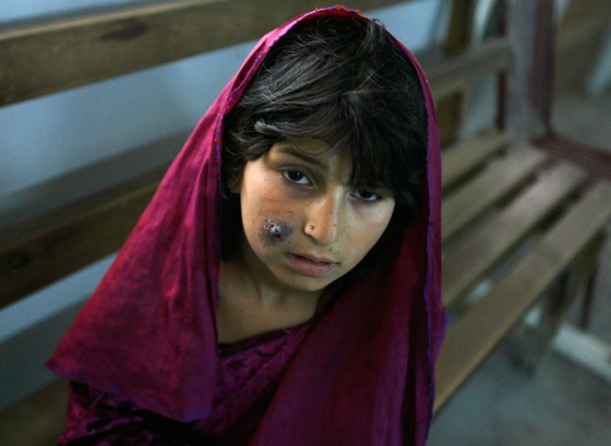Disfiguring skin disease plagues Afghanistan