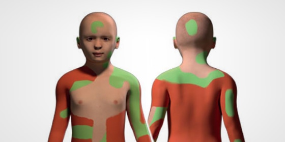 Green Skin Disorder