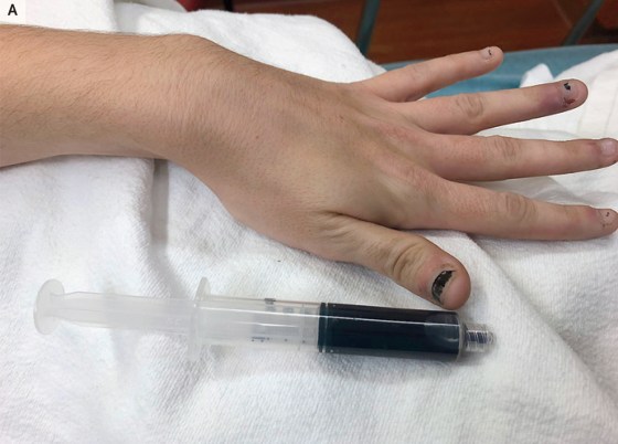 A common numbing medication turned a woman's blood blue