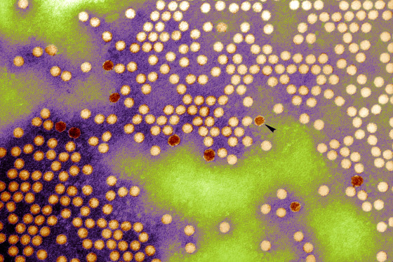 New York Health Officials Report 1st Case of Polio in the US Since 2013