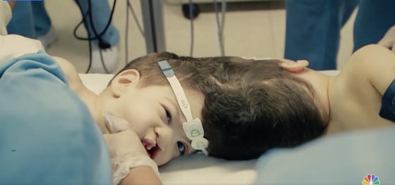 Craniopagus Twins Connected By Brain Successfully Separated