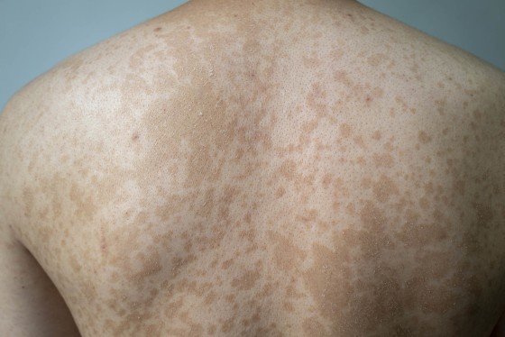 23 Pictures of Skin Rashes With Symptoms Treatments Expert Tips