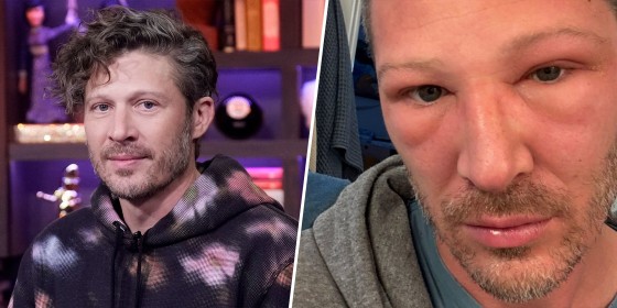 Actor Zach Gilford Shares Photos Of Swollen Face. What Caused It?