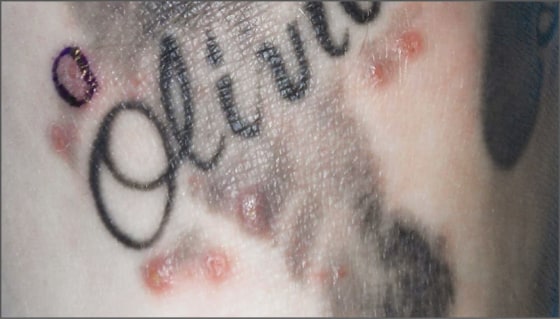 Infected tattoos linked to distilled water in ink