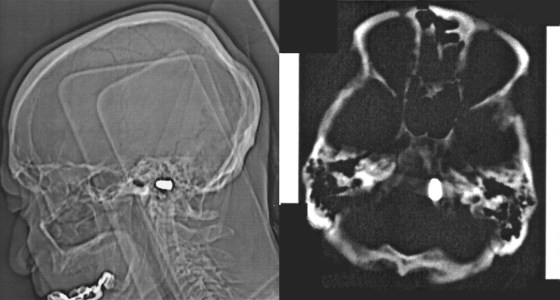 Engineer lived with bullet in his head for 8 decades