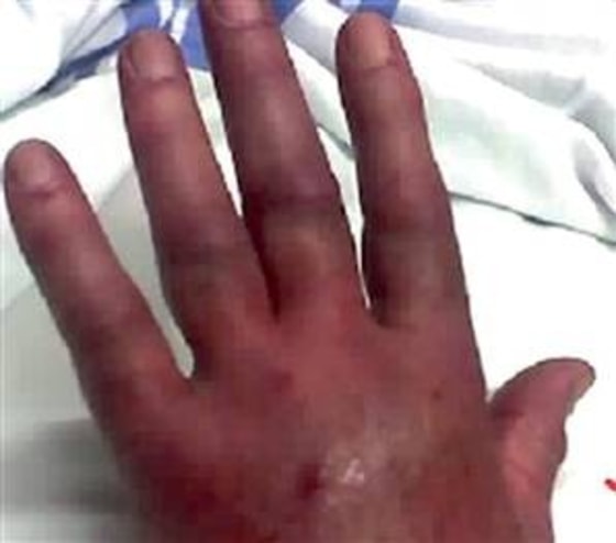 Purple Glove Syndrome leads FDA panel to review drug