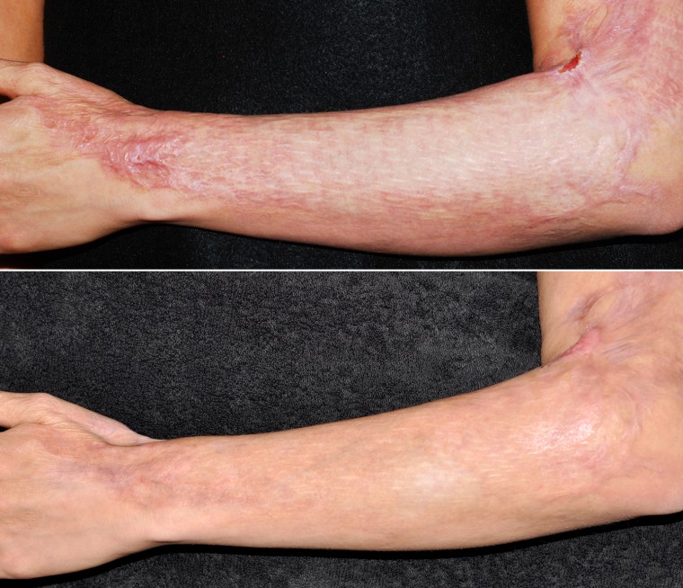 Image: Jordan Berns left arm in March (top) and September (bottom) of 2009.