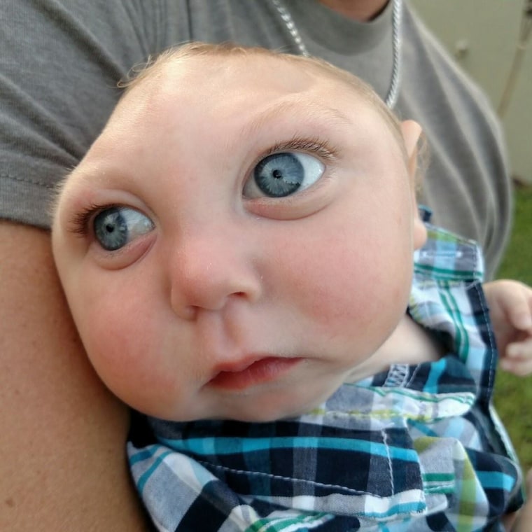  Jaxon Strong Baby Missing Part Of Brain Thrives Despite Odds