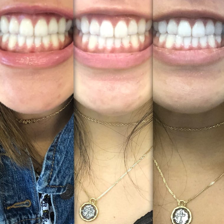 Do LED Teeth Whitening Kits Work I Tried Teeth Whitening At Home 