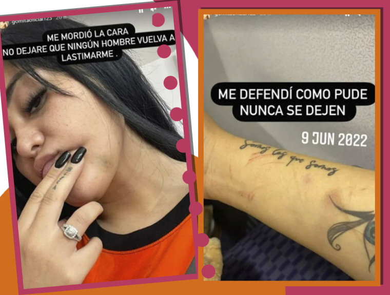 Gomita Narra Las Brutales Agresiones A Manos De Su Ex Novio “me Mordió