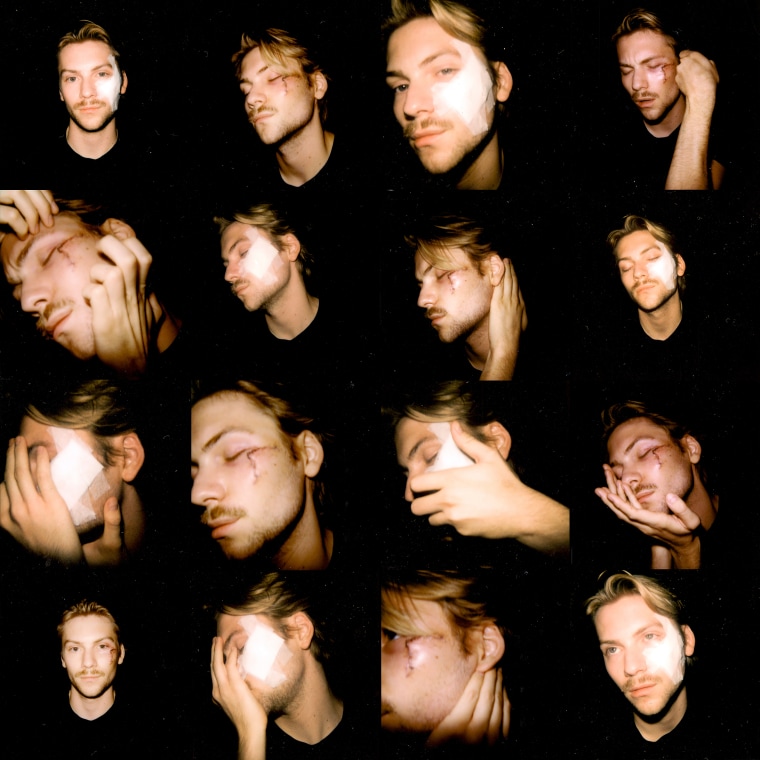 Man, 21, Photographs His Basal Cell Skin Cancer Symptoms, Surgery