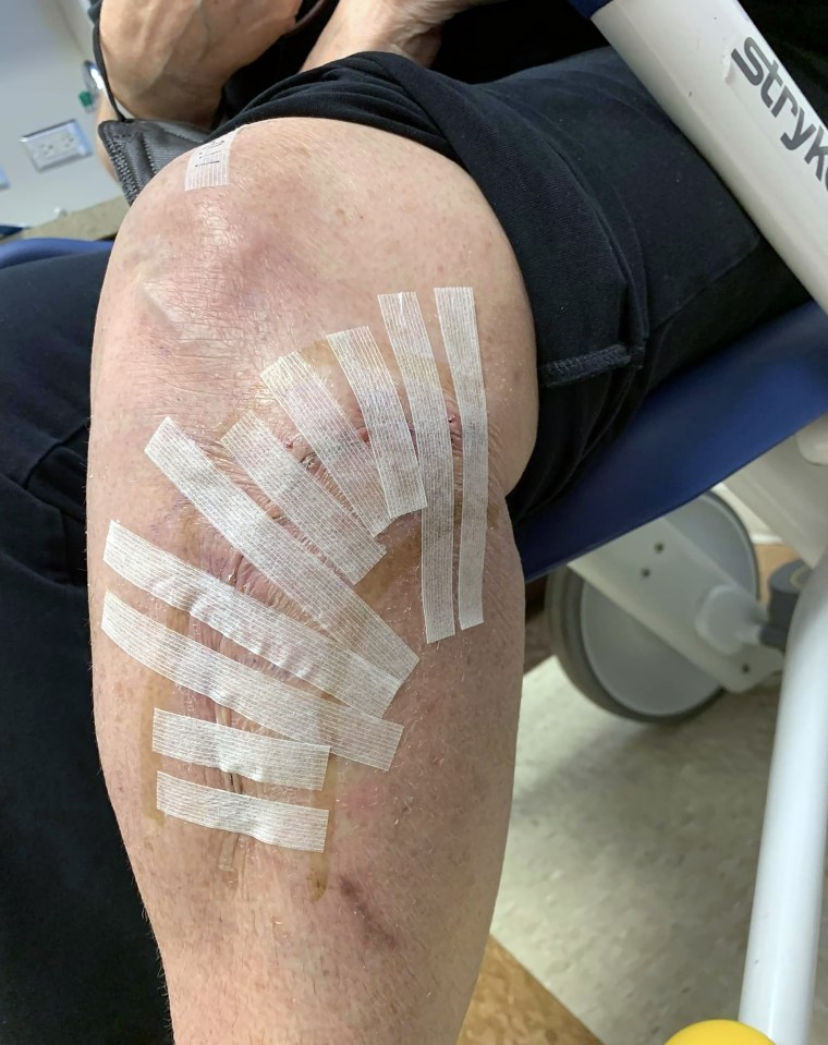 Woman Breaks Leg Walking On the Beach, Falling Into Hole In Sand