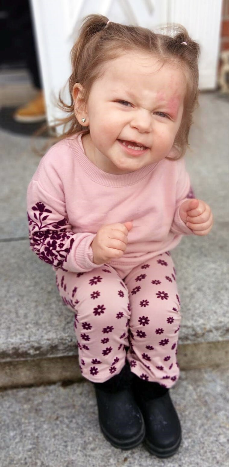 Port Wine Stain Connected to Sturge Weber Syndrome And Seizures