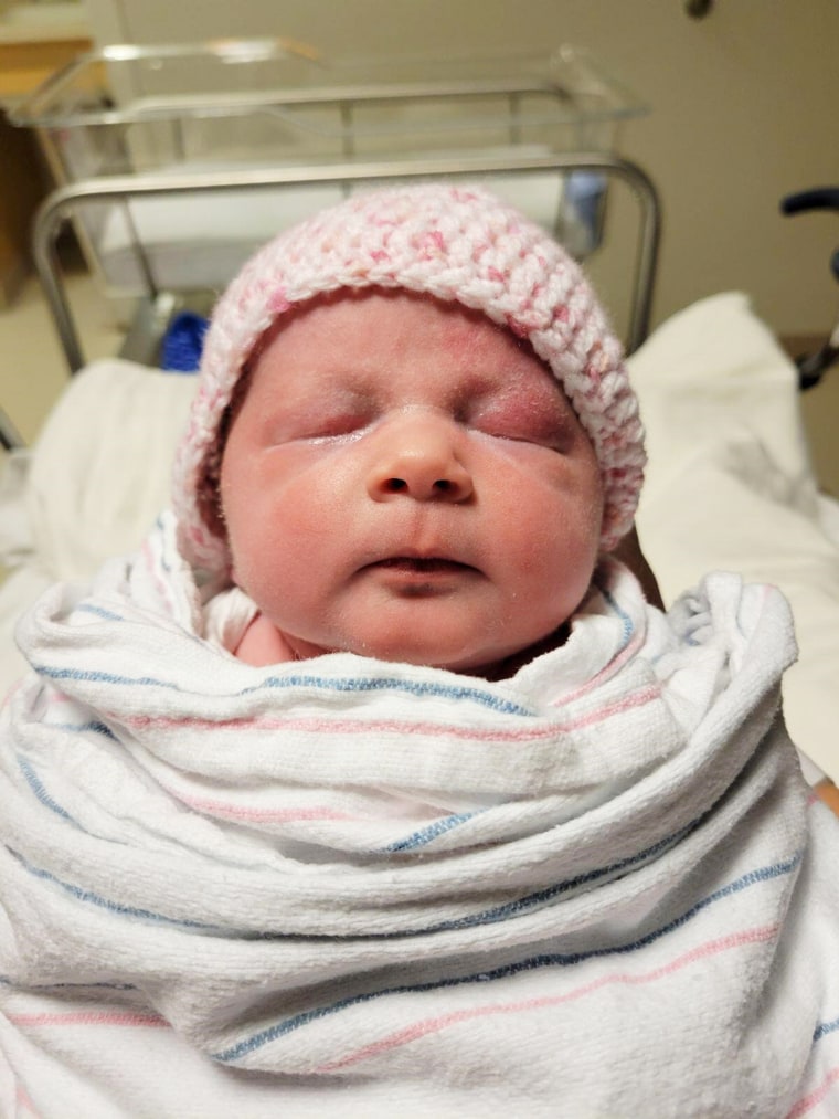 Port Wine Birthmark Port Wine Stain Connected To Sturge Weber Syndrome