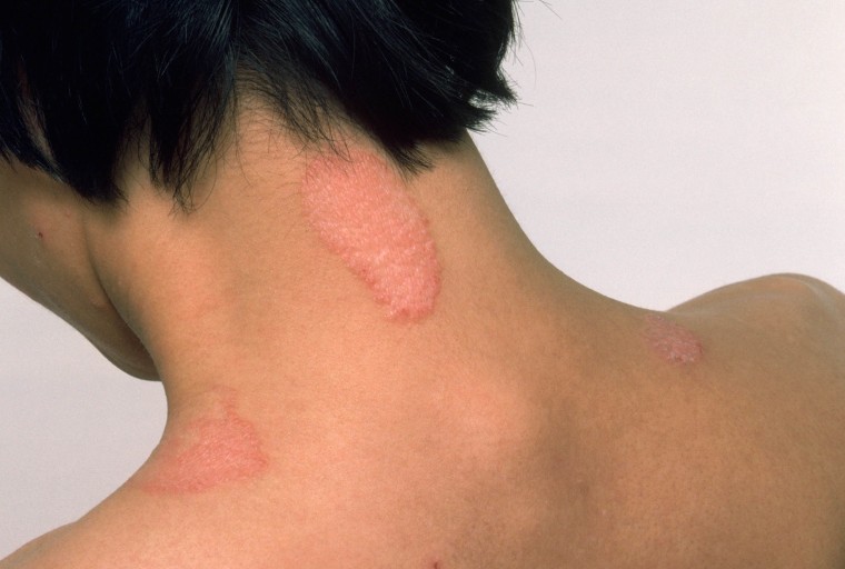 7 Types of Eczema With Photos and Tips to Identify