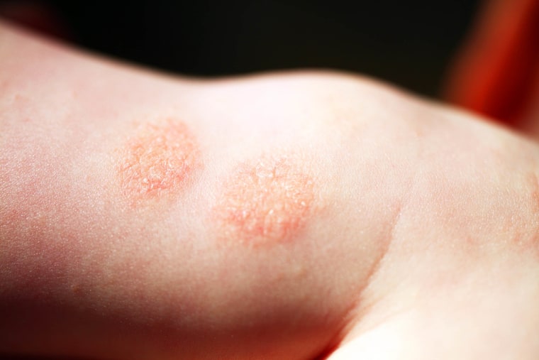 7 Types of Eczema With Photos and Tips to Identify