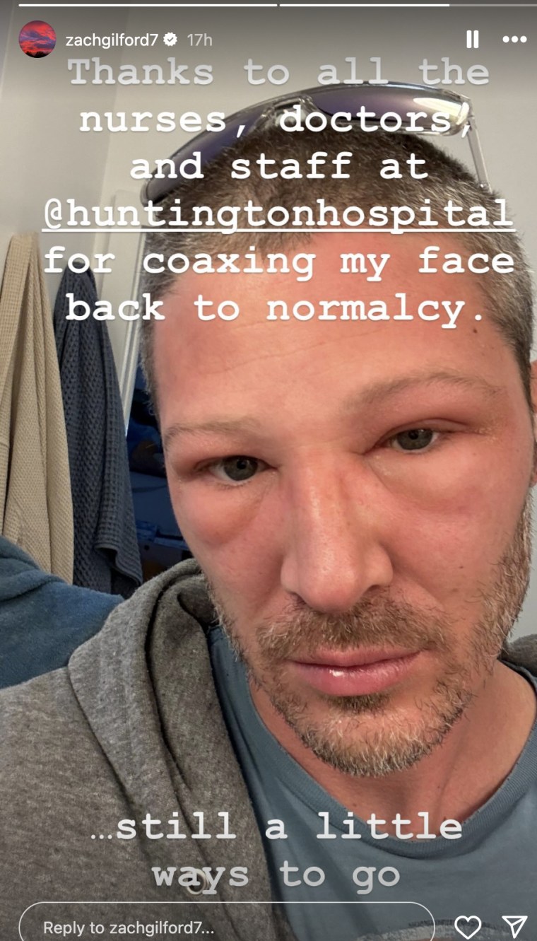 Actor Zach Gilford Shares Photos Of Swollen Face. What Caused It?