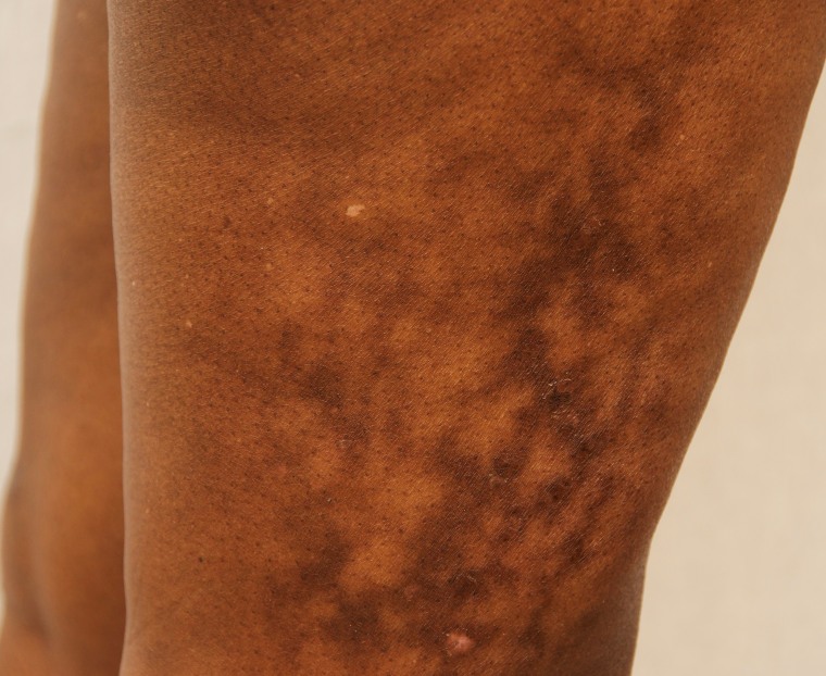 What Is Toasted Skin Syndrome? Cause, Signs and How To Treat It