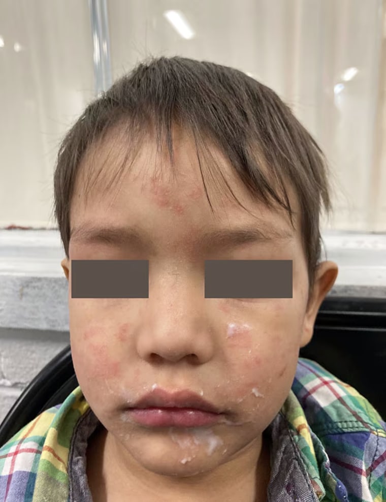 Measles Rash Pictures Common Signs Tips To Identify Measles Measles Rash Pictures Common Signs Tips To Identify Measles