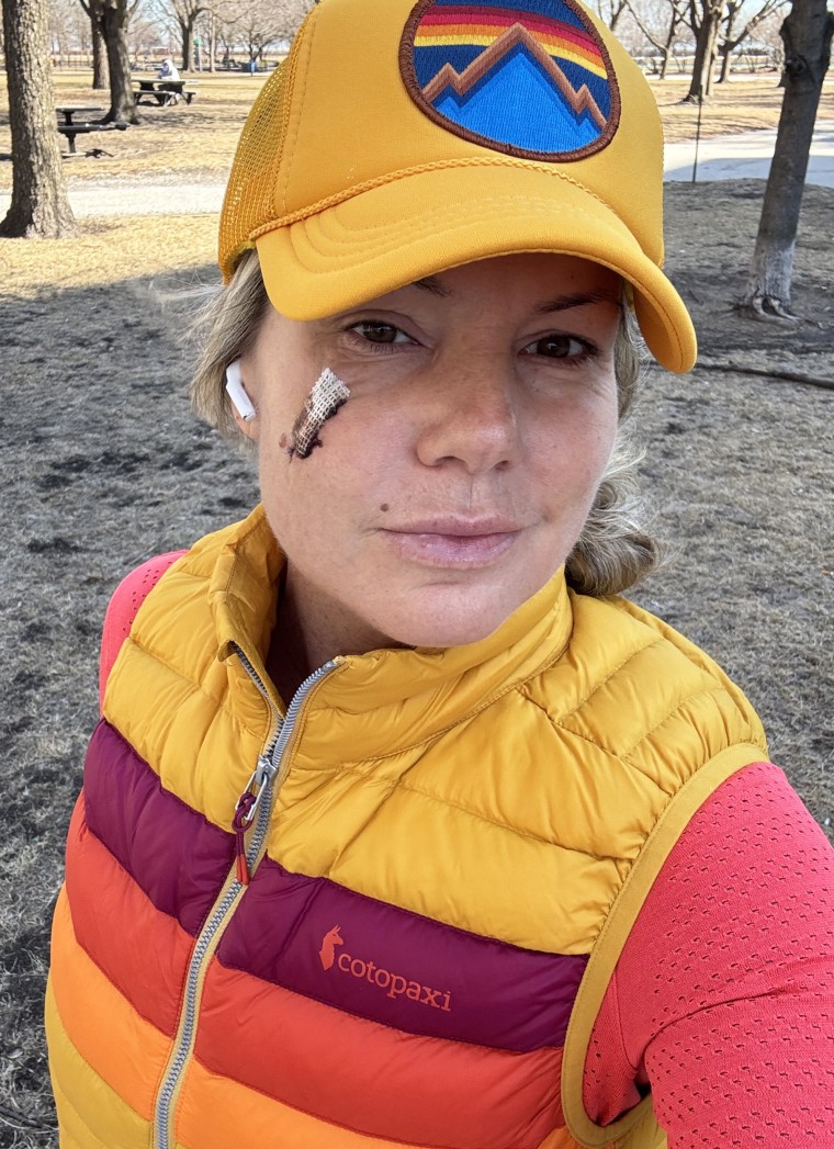 Woman, 43, Shocked When Melanoma Skin Cancer Grows On Face
