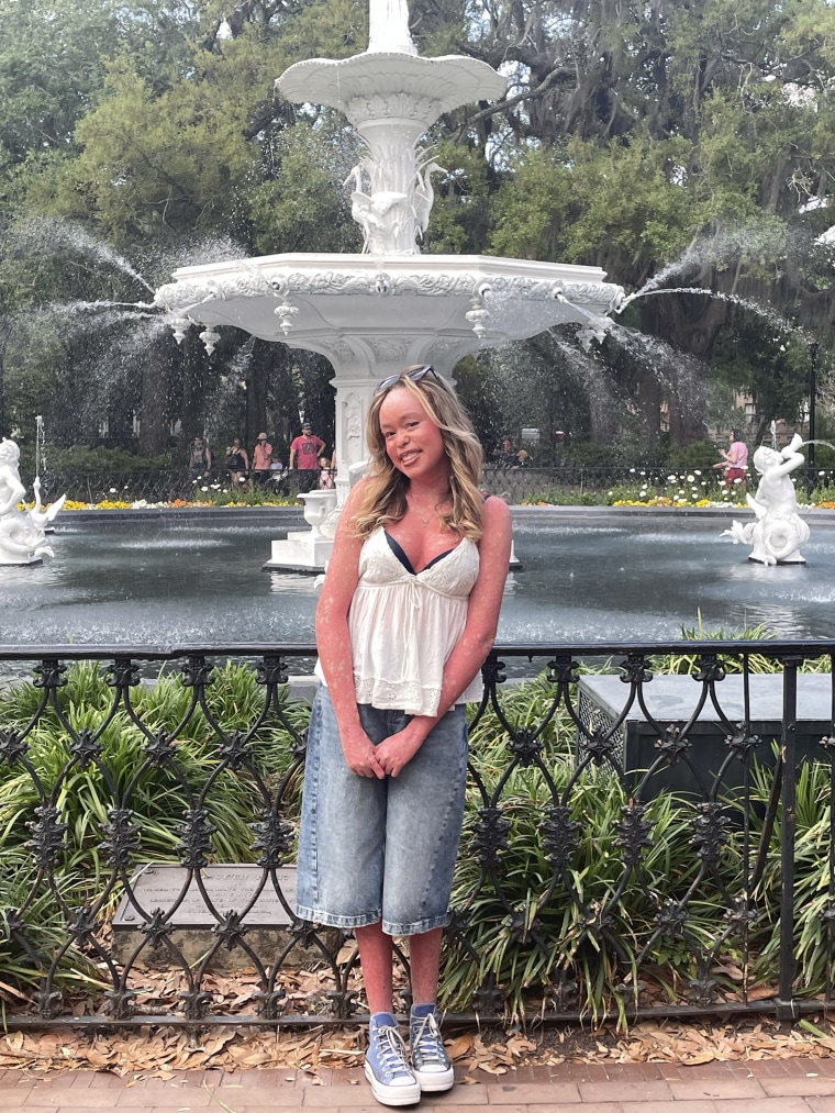 Teen With Ichthyosis With Confetti Goes Viral on TikTok: 'Shed the Stigma'