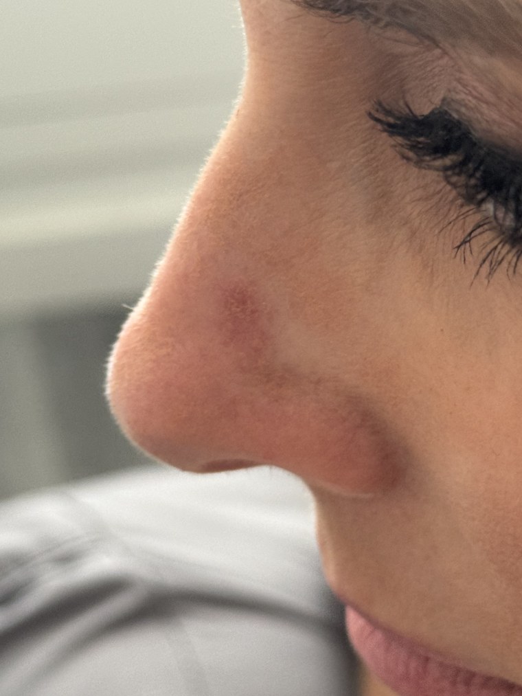 Woman's 'Tiny Little Spot' Turns Out to Be 'Aggressive' Skin Cancer