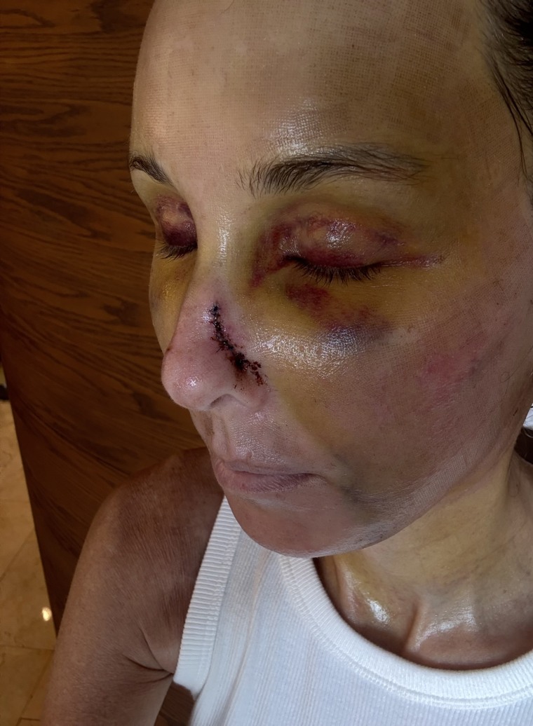 Woman's 'Tiny Little Spot' Turns Out to Be 'Aggressive' Skin Cancer