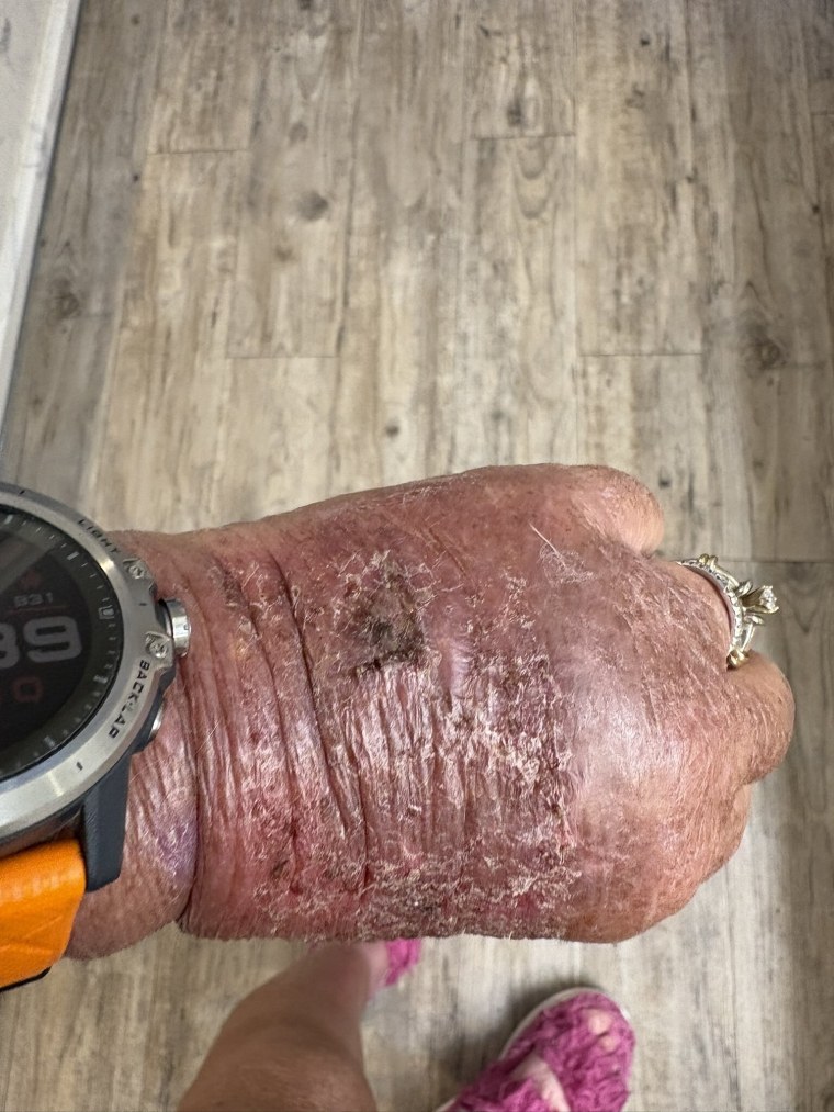 Paper Cut Turns Into Massive Infection On Woman's Hand: EXLUSIVE