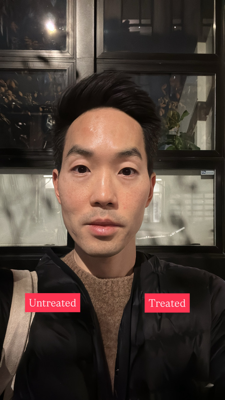New Korean Skin-Tightening Device Gets Rave Reviews. See the Results