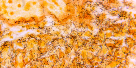 Sexual Health News: STDs, Viruses, Contraceptive Methods & More | NBC News