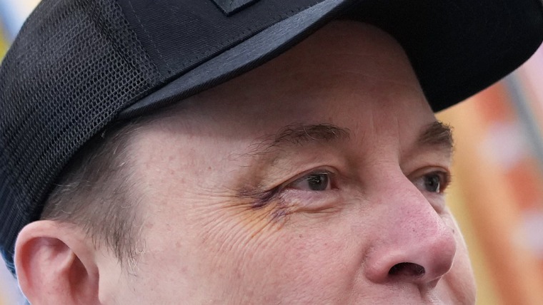 Elon Musk says bruised eye is from his son, X