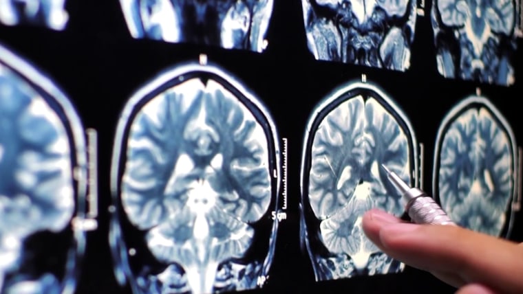 Astronauts' brains change shape and position in space: study